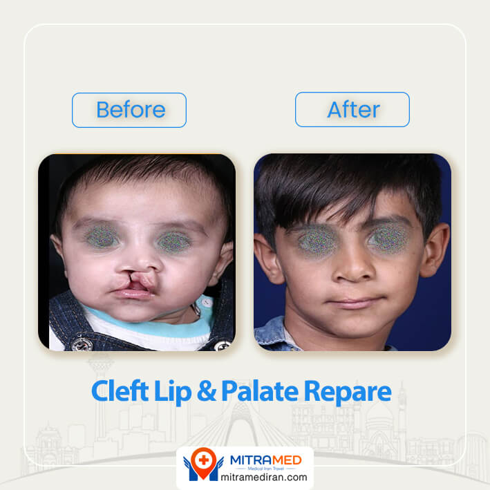 Cleft lip & Palate Repair Surgery in Iran | MITRAMED